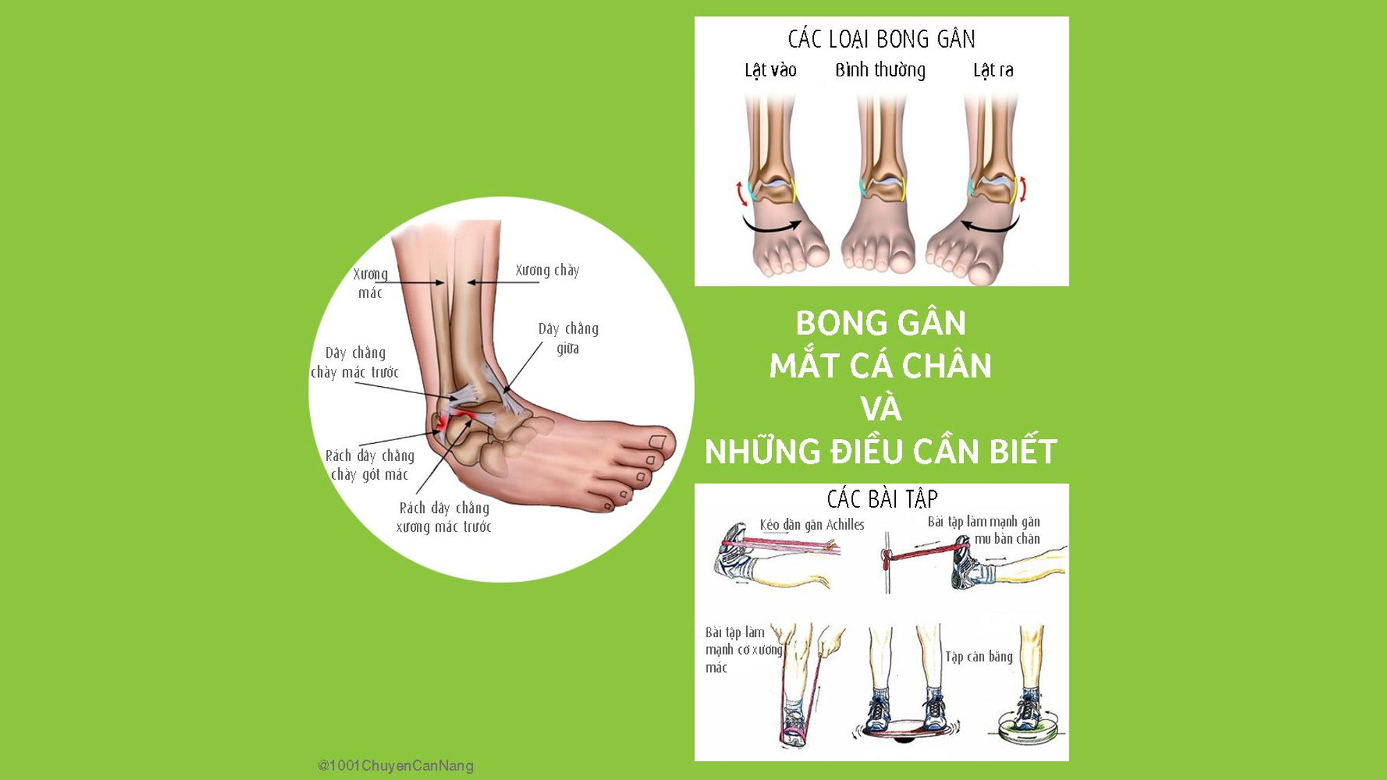 Bong gân mắt cá chân và những điều cần biết - 1001 Chuyện Cân Nặng